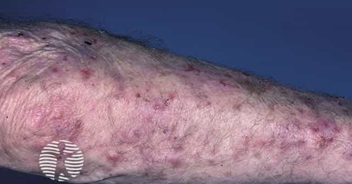 Dermatitis herpetiformis image