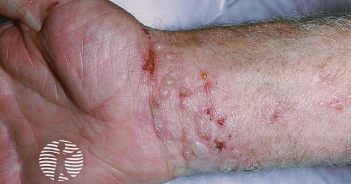 Dermatitis herpetiformis image