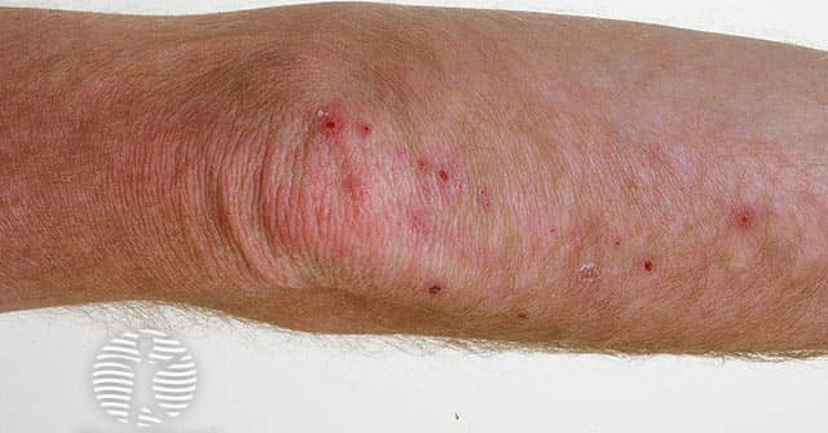 Dermatitis herpetiformis image