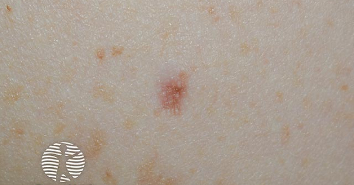 Dermatofibroma image