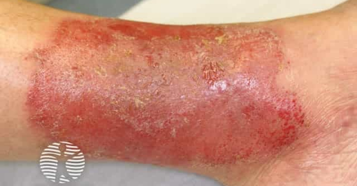 Discoid eczema image