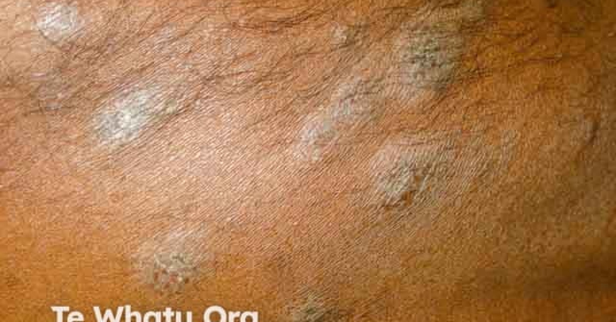 Discoid eczema image