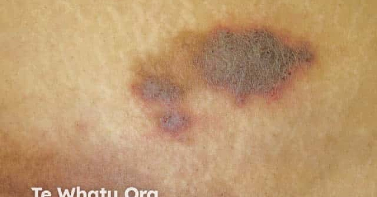 Discoid eczema image
