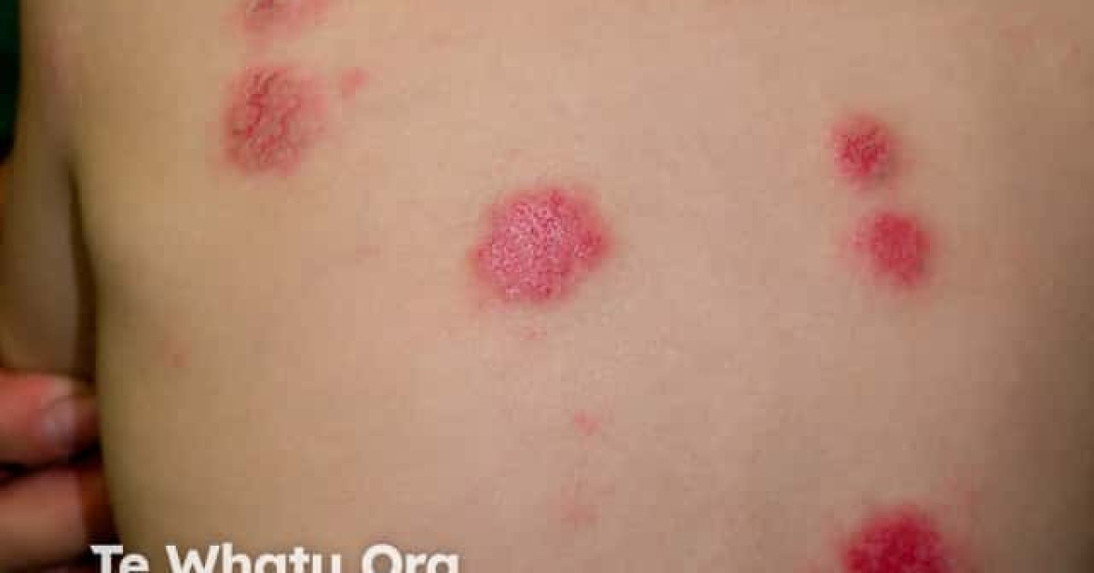 Discoid eczema image