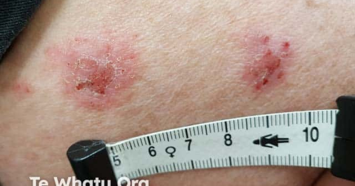 Discoid eczema image
