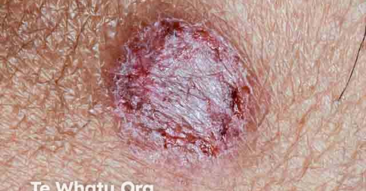 Discoid eczema image