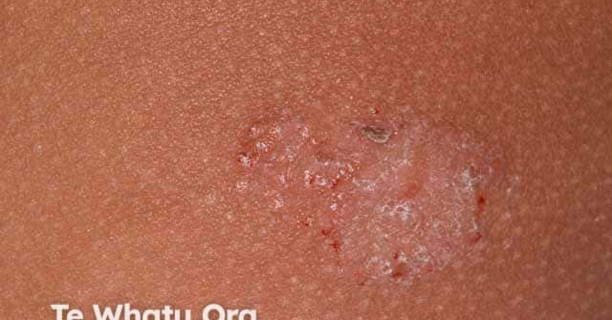 Discoid eczema image