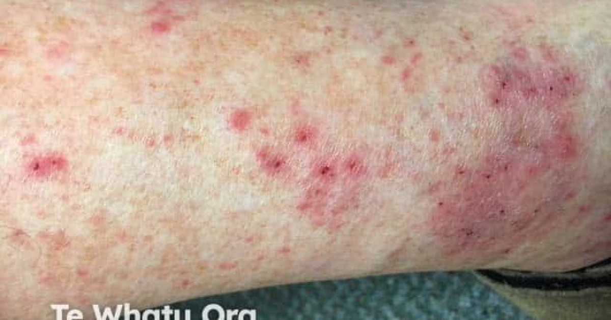 Discoid eczema image