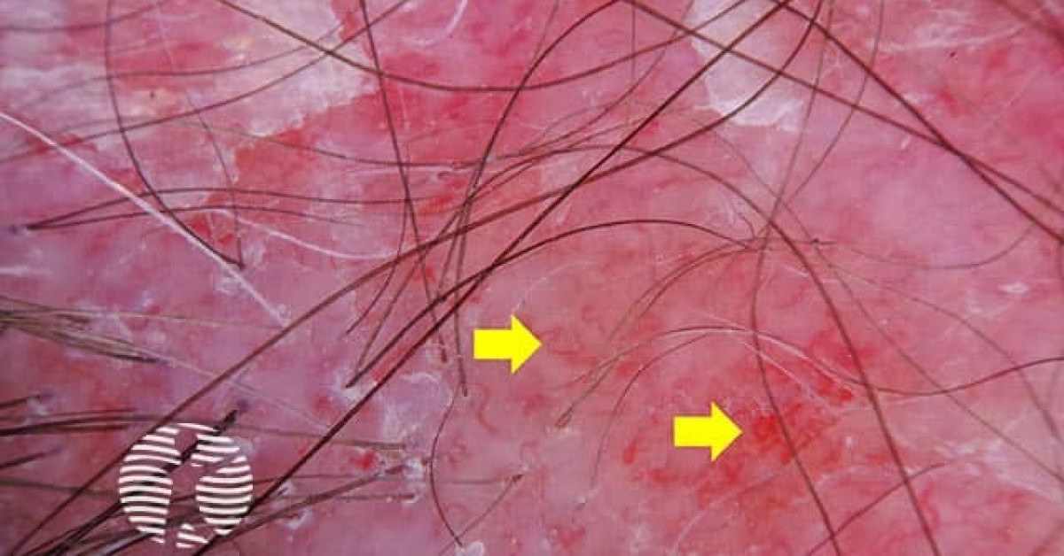 Discoid lupus erythematosus image