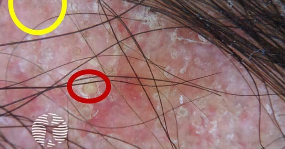 Discoid lupus erythematosus image