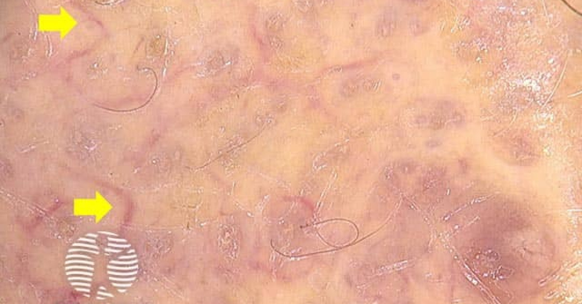 Discoid lupus erythematosus image