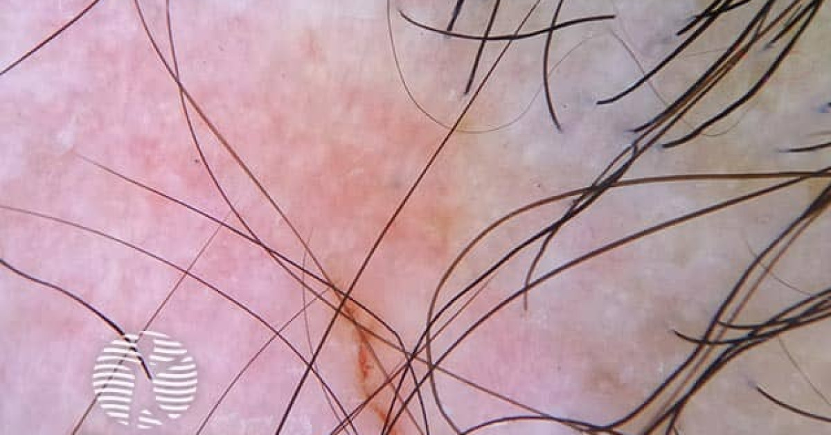 Discoid lupus erythematosus image