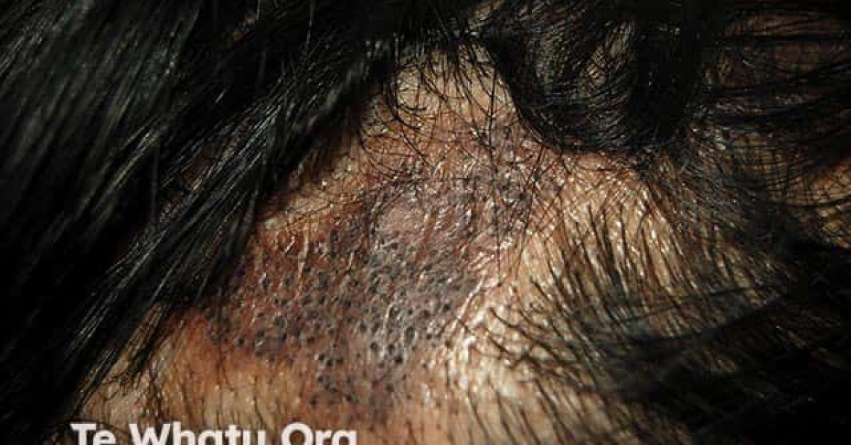 Discoid lupus erythematosus image