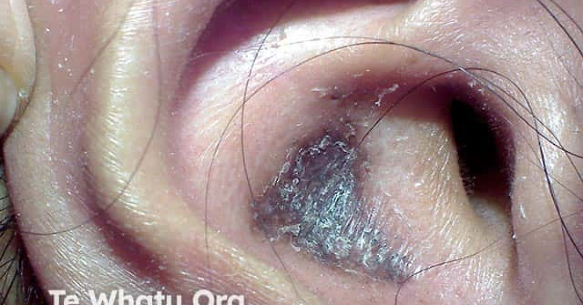 Discoid lupus erythematosus image