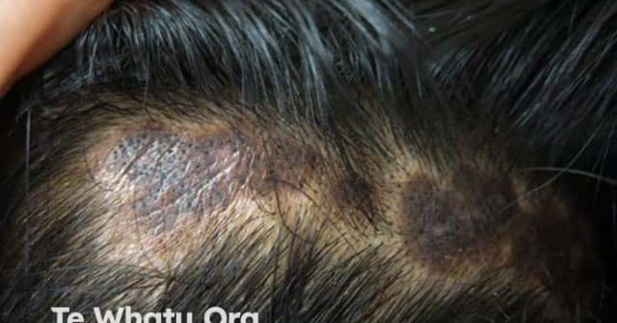 Discoid lupus erythematosus image