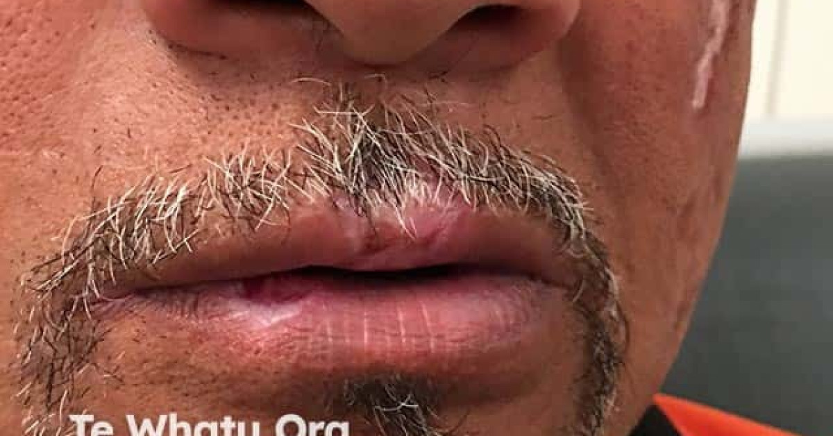 Discoid lupus erythematosus image