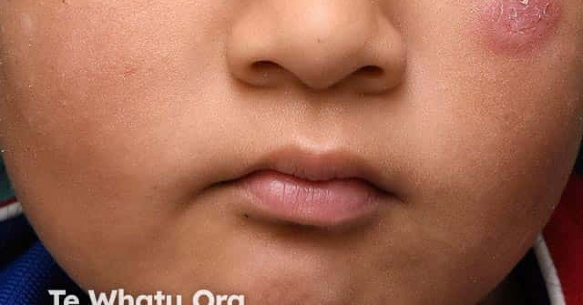 Discoid lupus erythematosus image