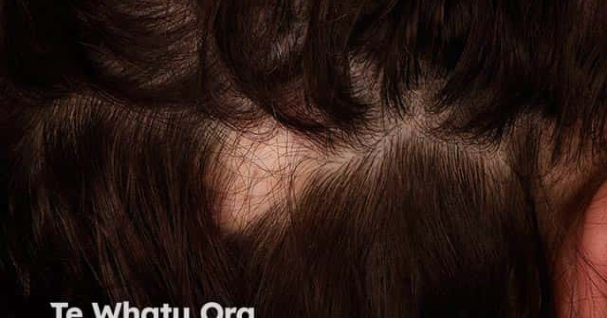 Discoid Lupus Erythematosus Image