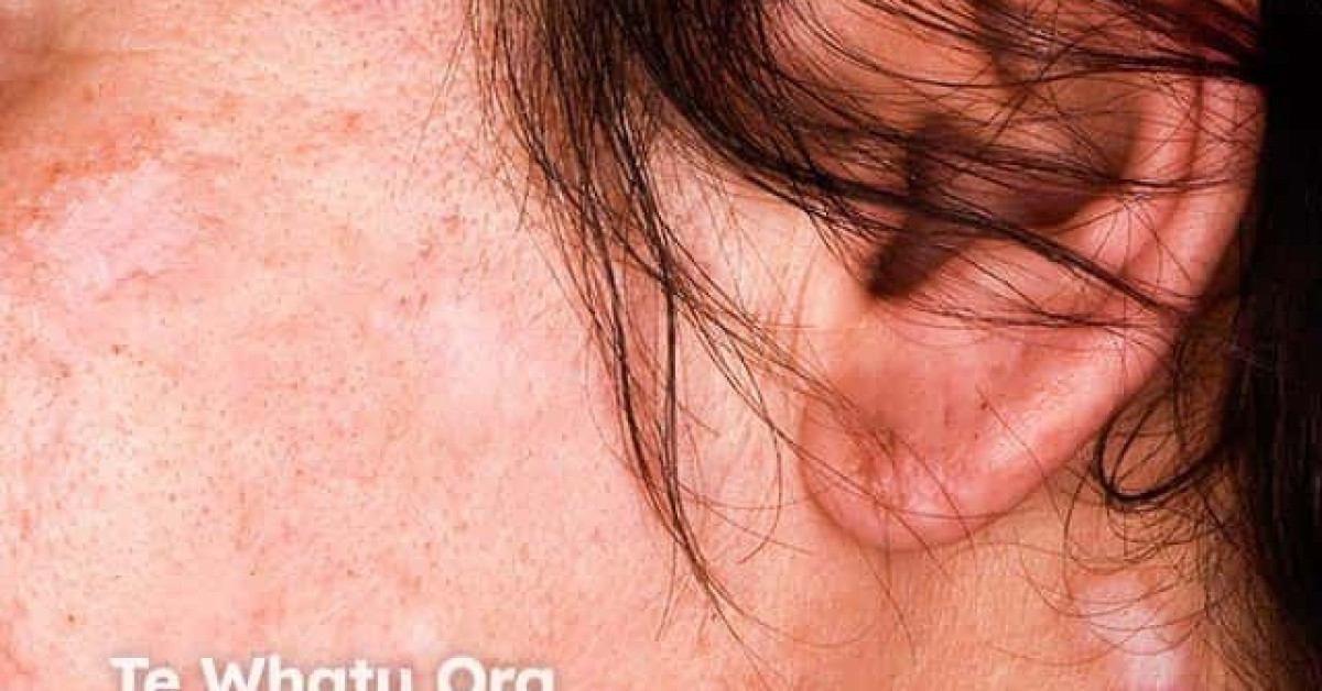 Discoid lupus erythematosus image