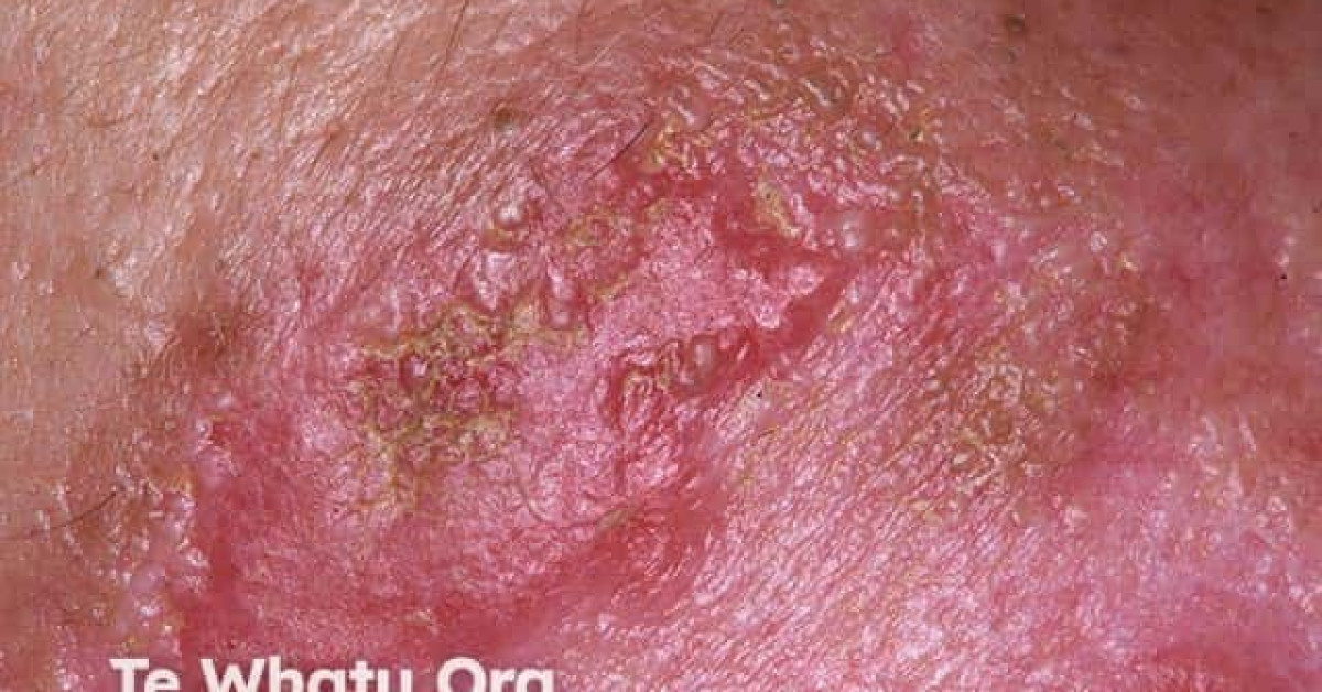 Discoid lupus erythematosus image