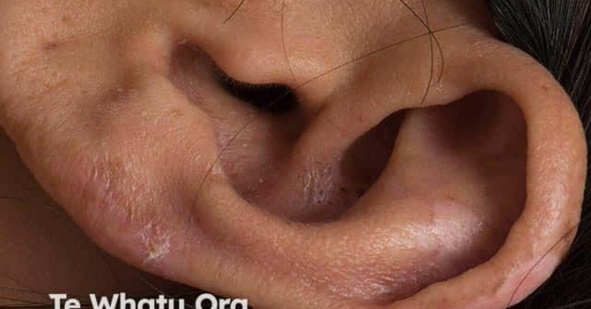 Discoid lupus erythematosus image