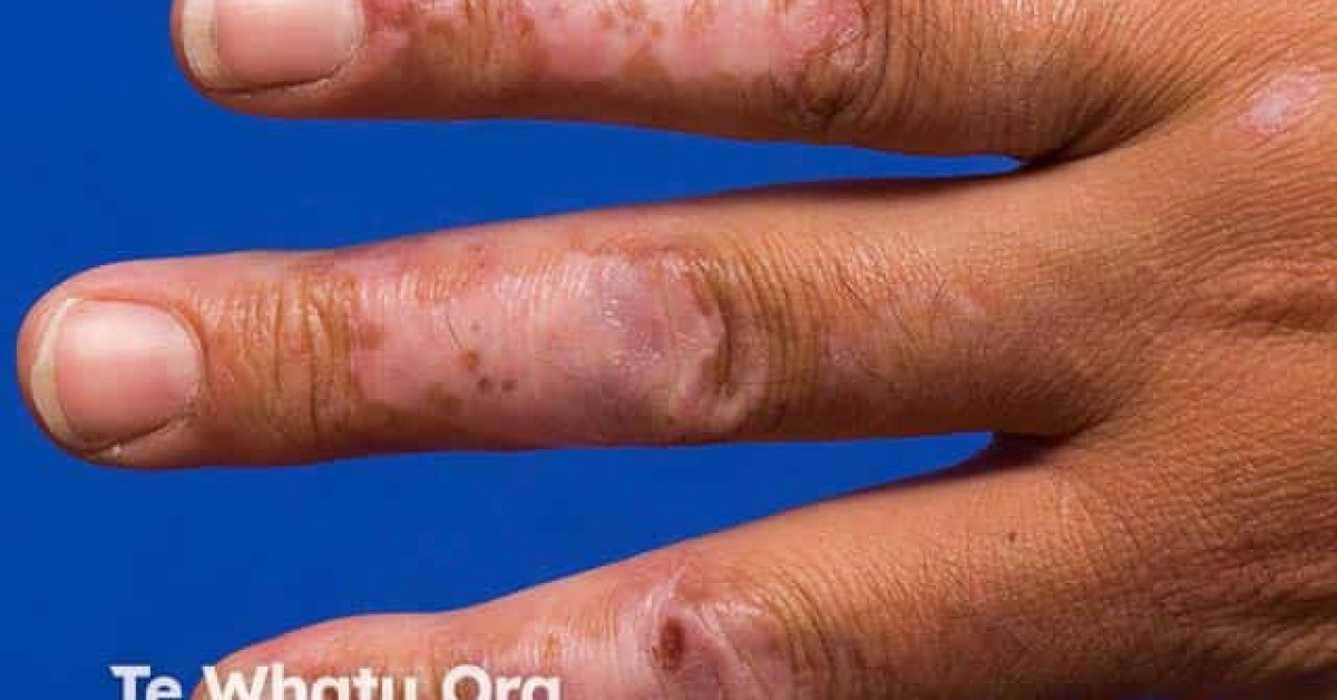 Discoid lupus erythematosus image