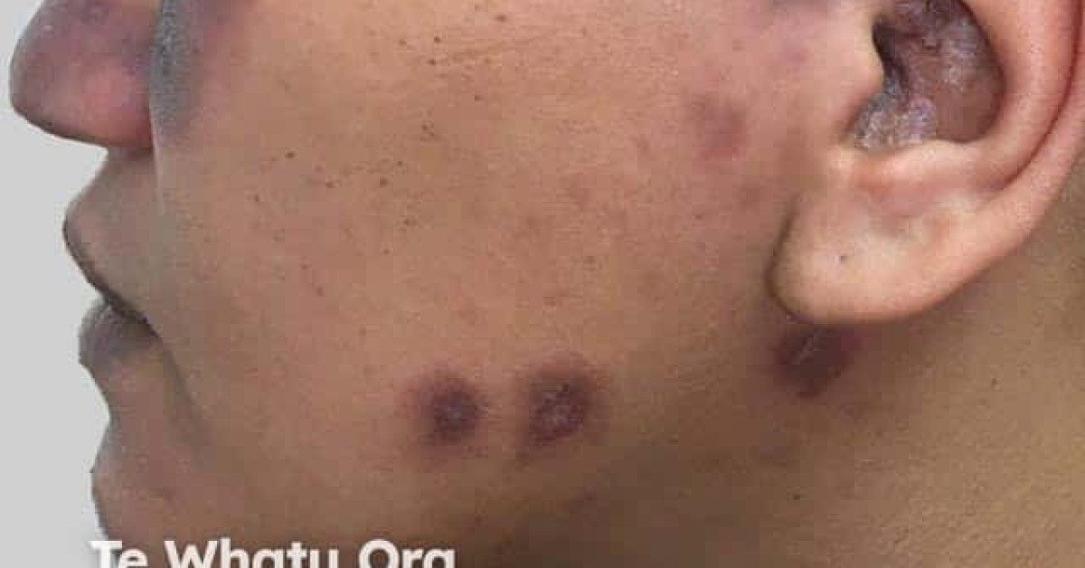 Discoid lupus erythematosus image