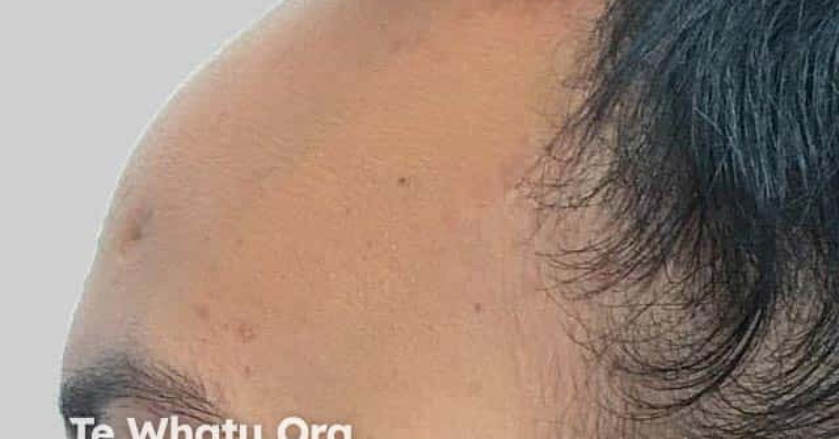 Discoid lupus erythematosus image