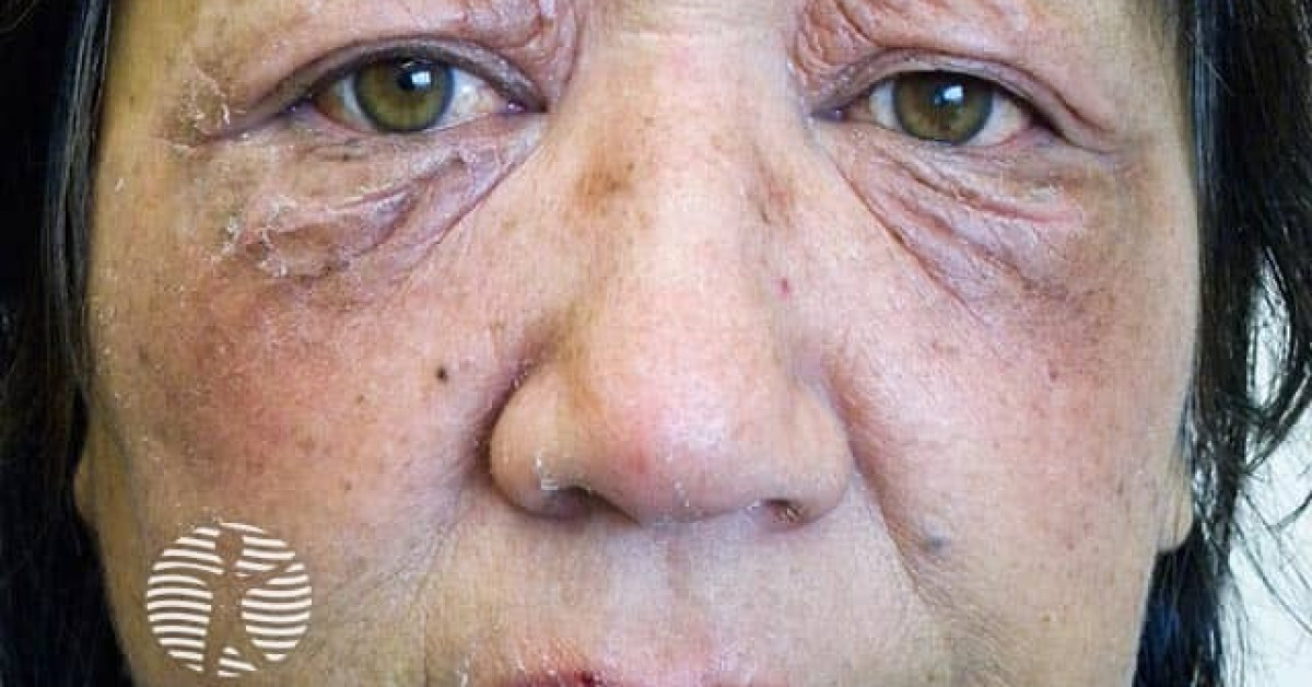 Drug-induced photosensitivity image