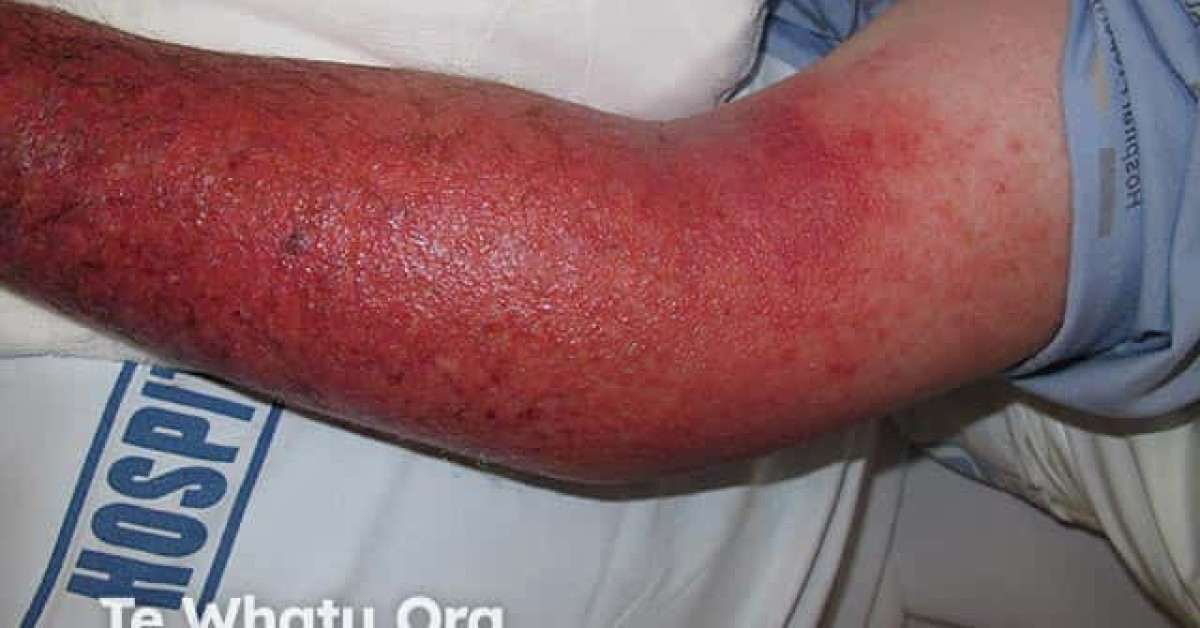 Drug-induced photosensitivity image