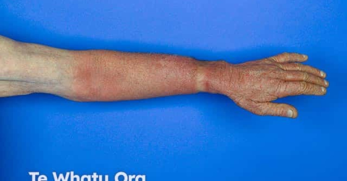 Drug-induced photosensitivity image