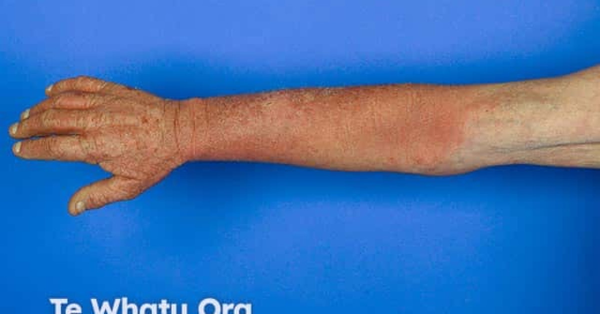 Drug-induced photosensitivity image