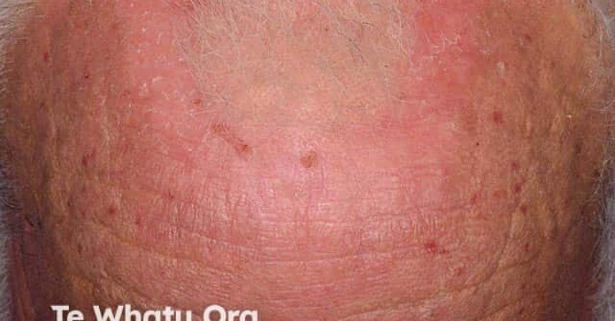 Drug-induced photosensitivity image