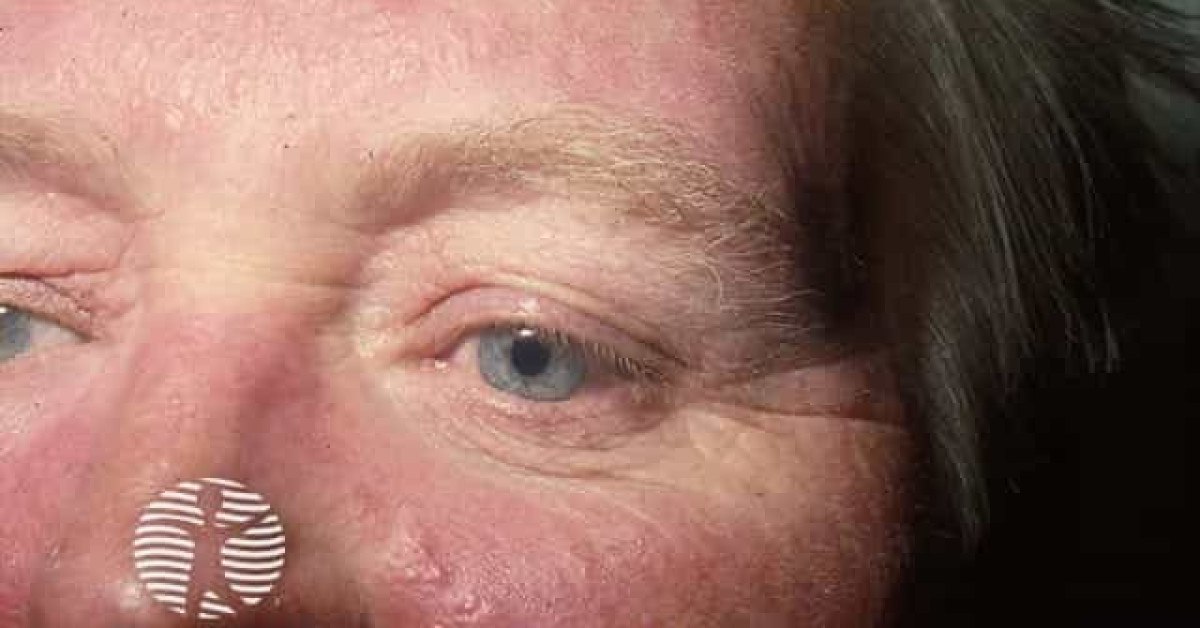 Drug-induced photosensitivity image