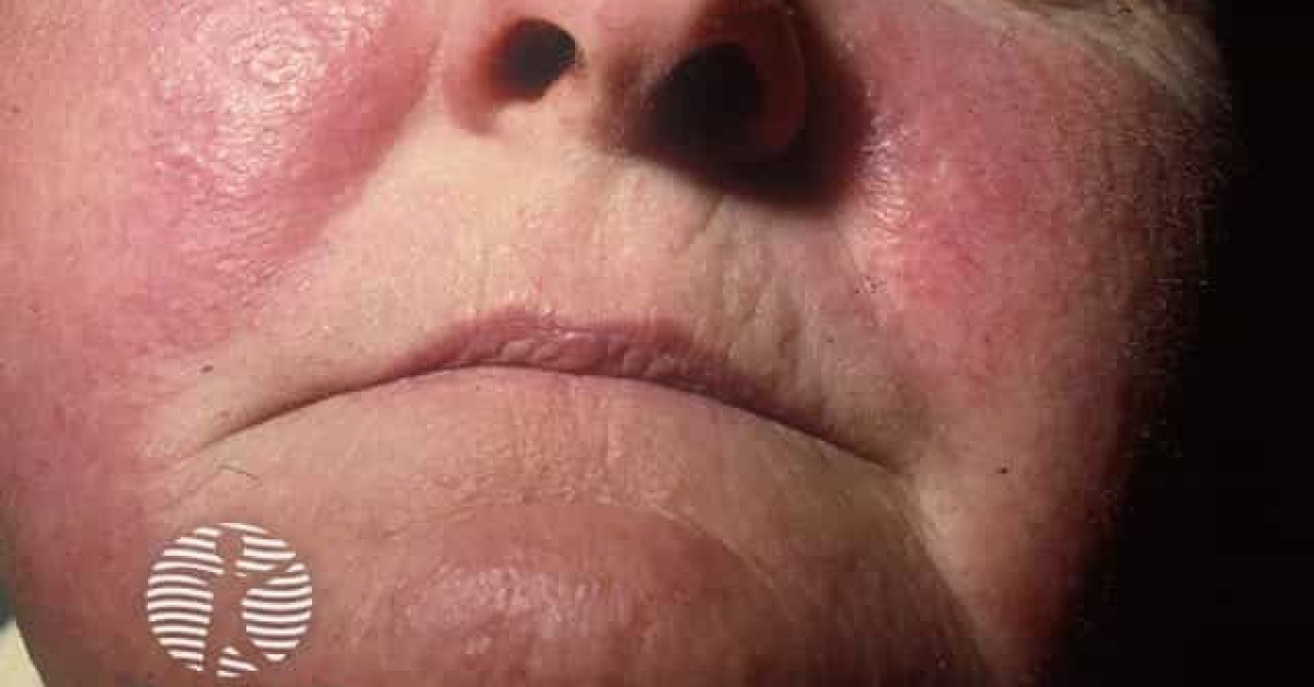 Drug-induced photosensitivity image