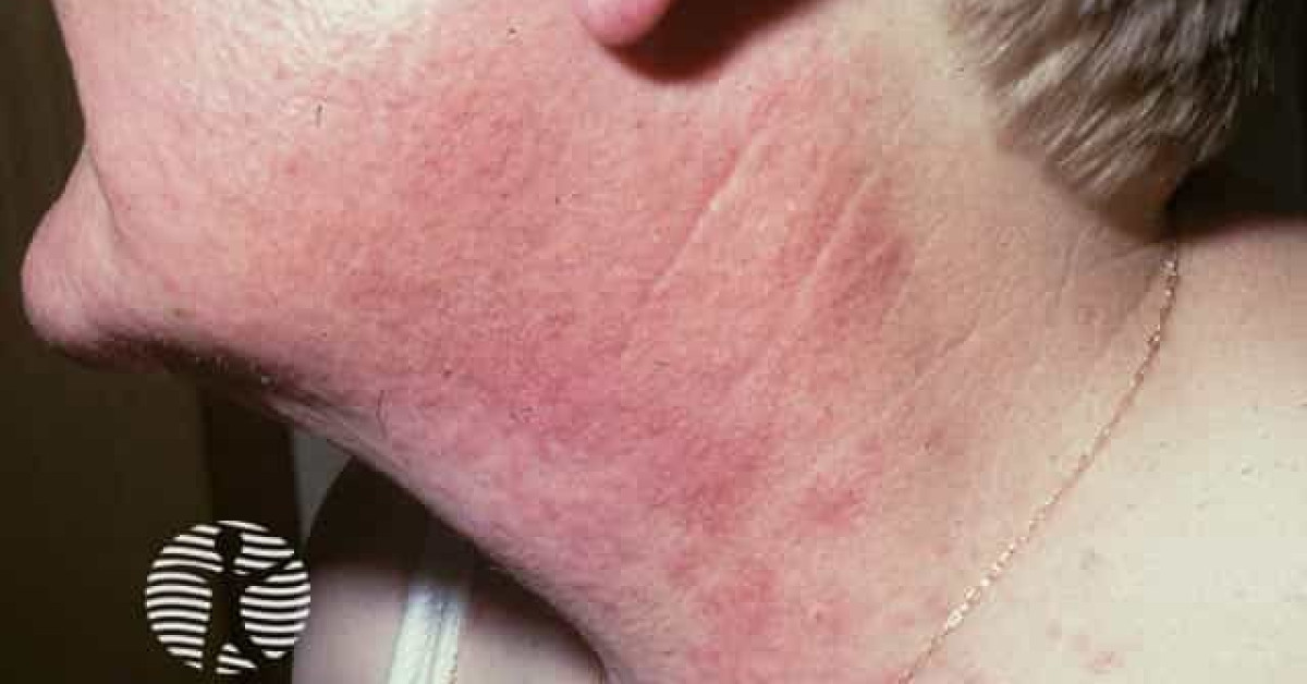 Drug-induced photosensitivity image