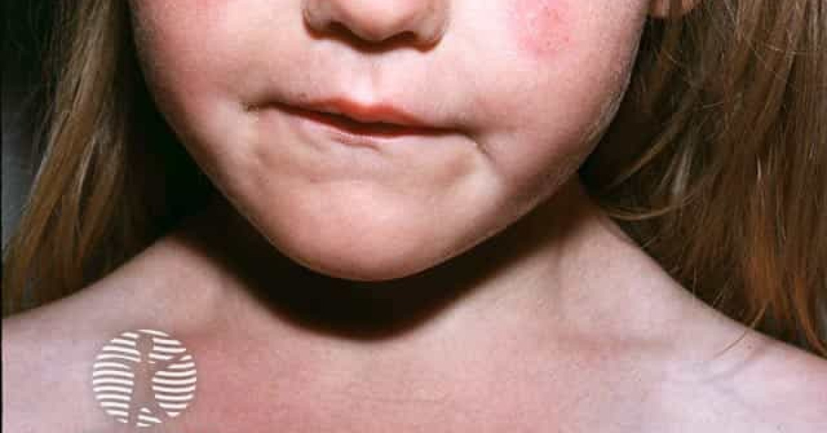 Drug-induced photosensitivity image