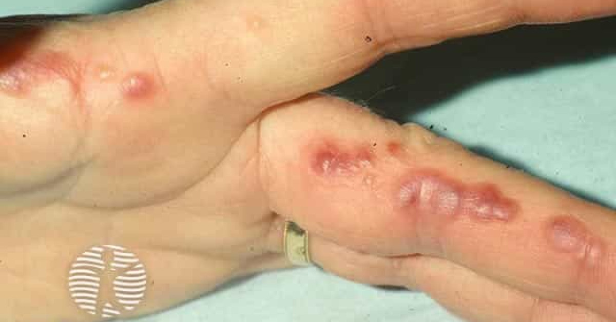 Dyshidrotic eczema (pompholyx) image