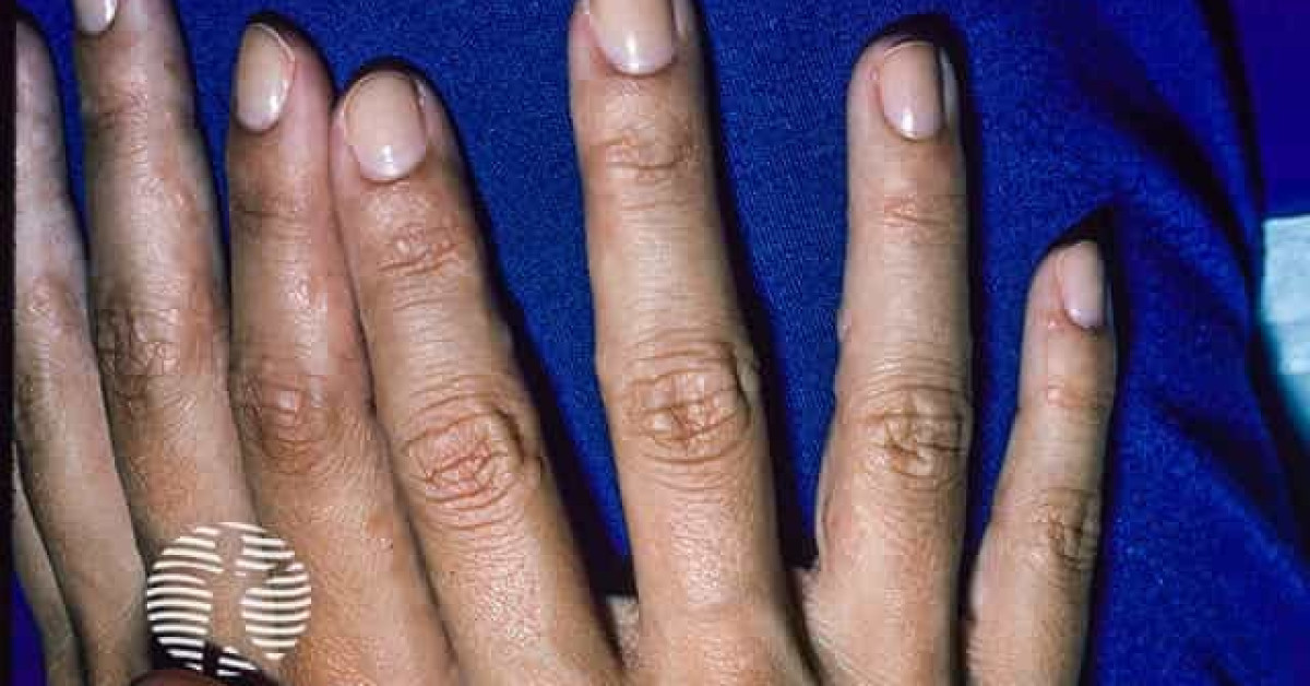 Dyshidrotic eczema (pompholyx) image
