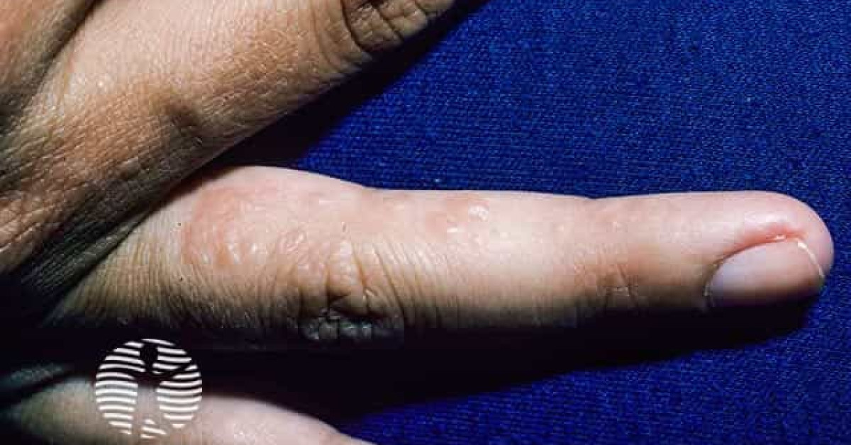 Dyshidrotic eczema (pompholyx) image