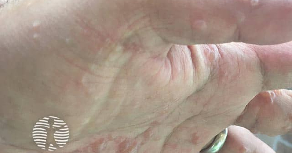 Dyshidrotic eczema (pompholyx) image