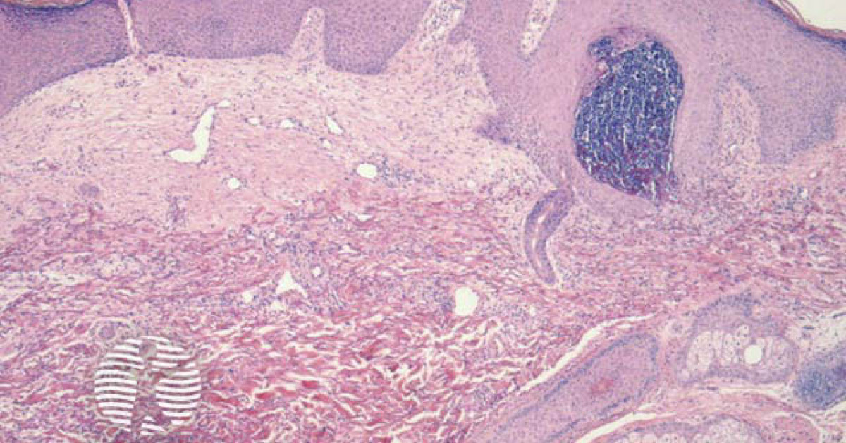 Elastosis perforans serpiginosa histopathology image
