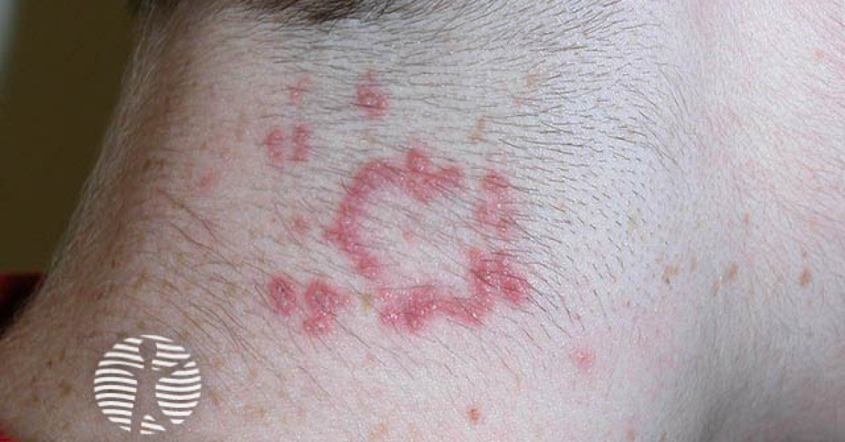 Elastosis perforans serpiginosa image