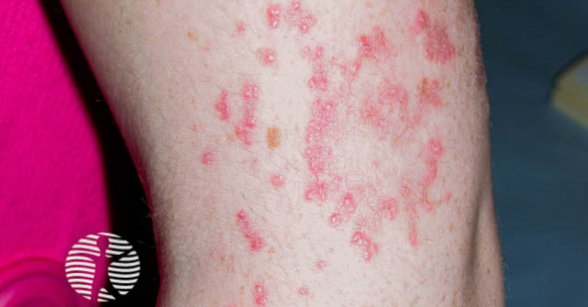 Elastosis perforans serpiginosa image