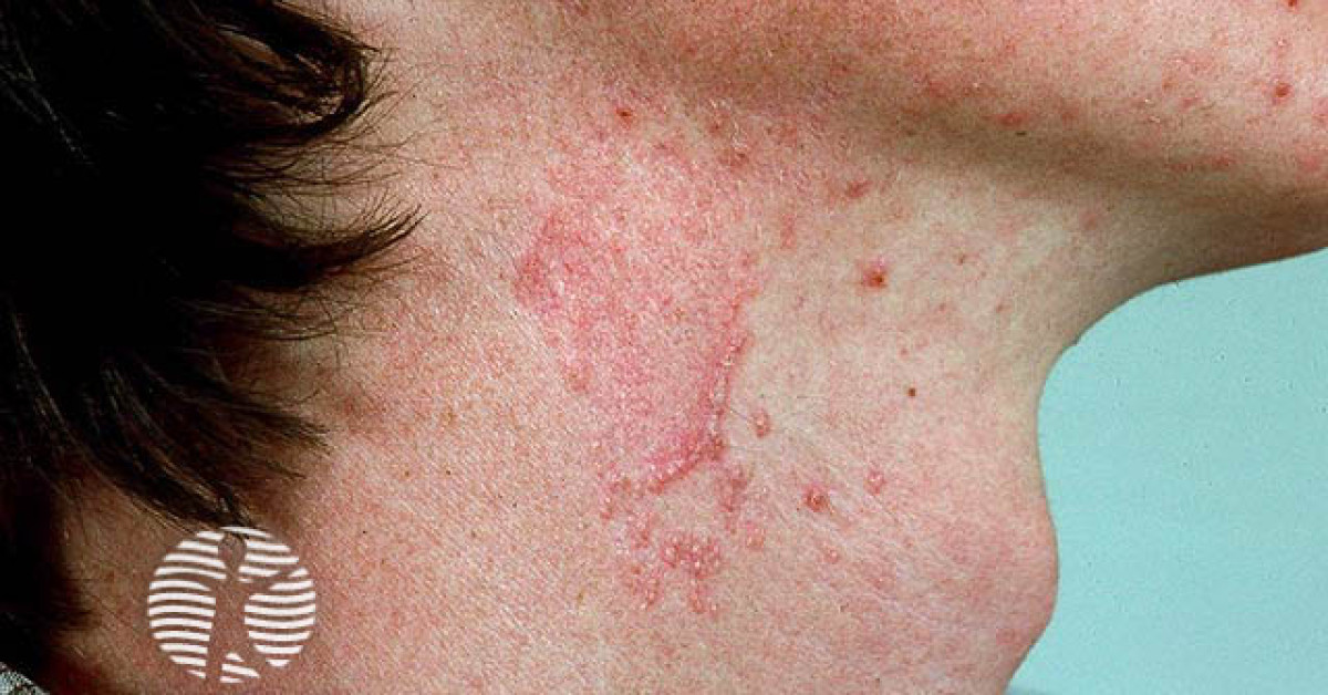 Elastosis perforans serpiginosa image