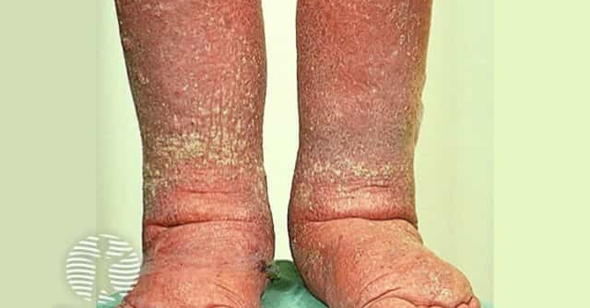 Dermnet® Elephantiasis Nostras Verrucosa Image