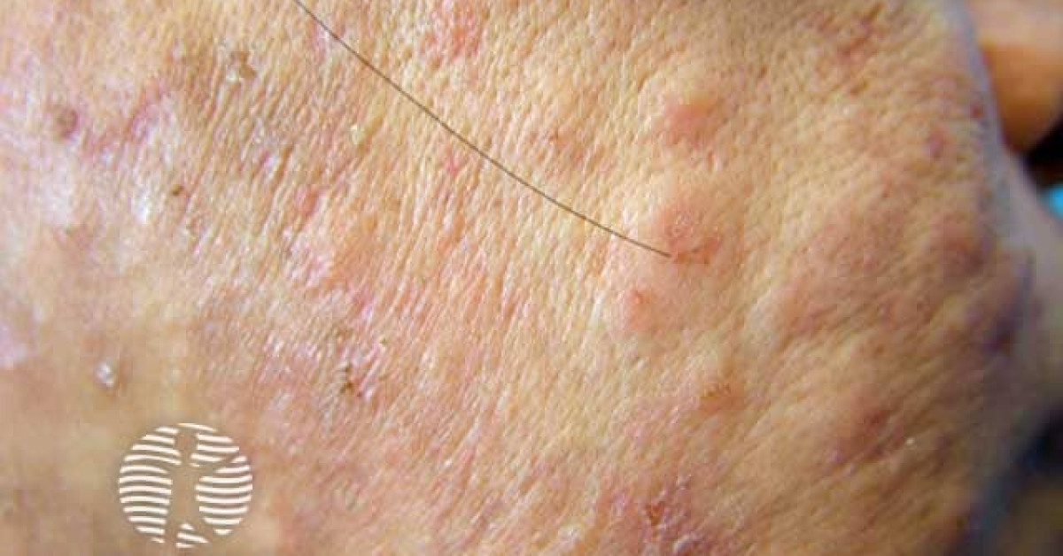 Eosinophilic pustular folliculitis image