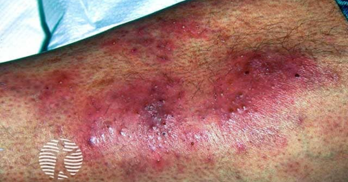 Eosinophilic pustular folliculitis image