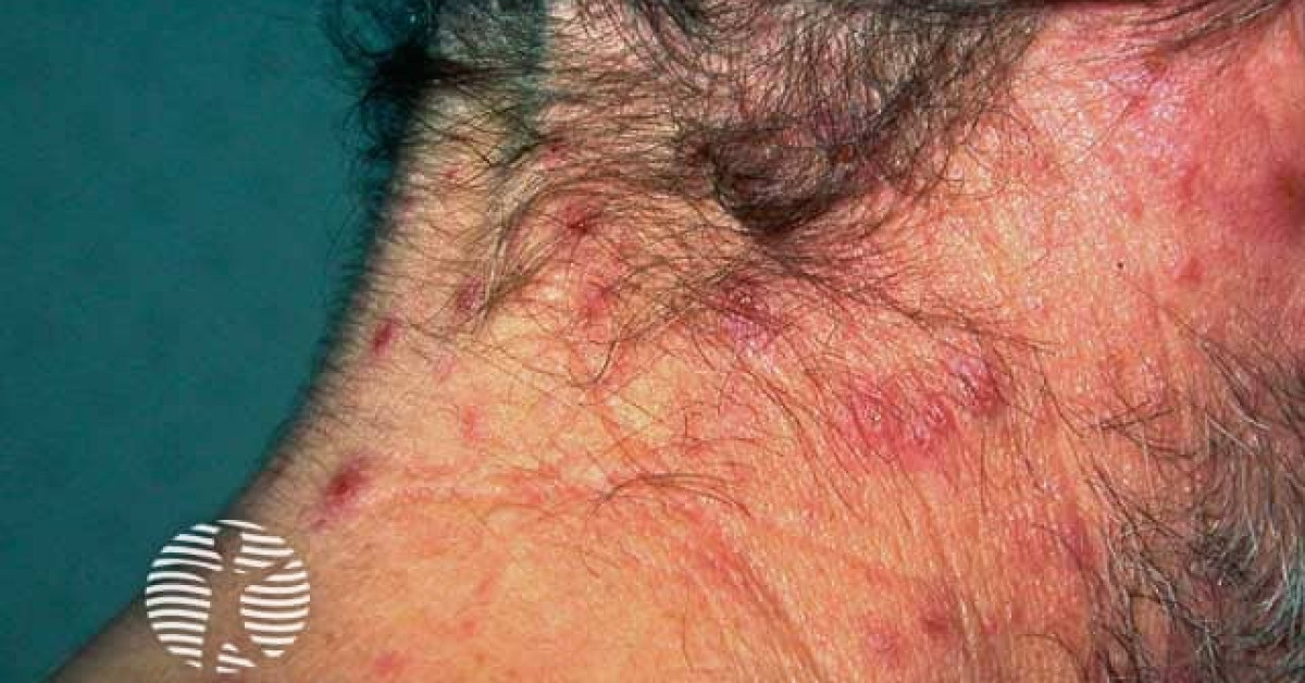 Eosinophilic pustular folliculitis image