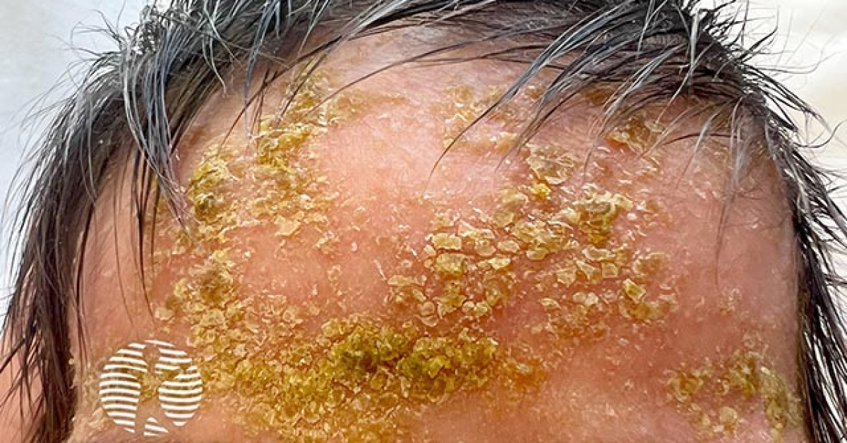 Eosinophilic pustular folliculitis image